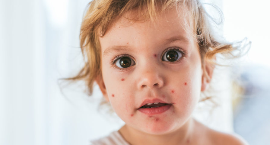 Chicken Pox: Common Signs of Chickenpox - ActiveBeat