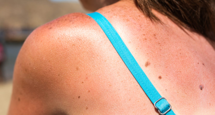 Factors That Increase Your Risk of Skin Cancer - ActiveBeat
