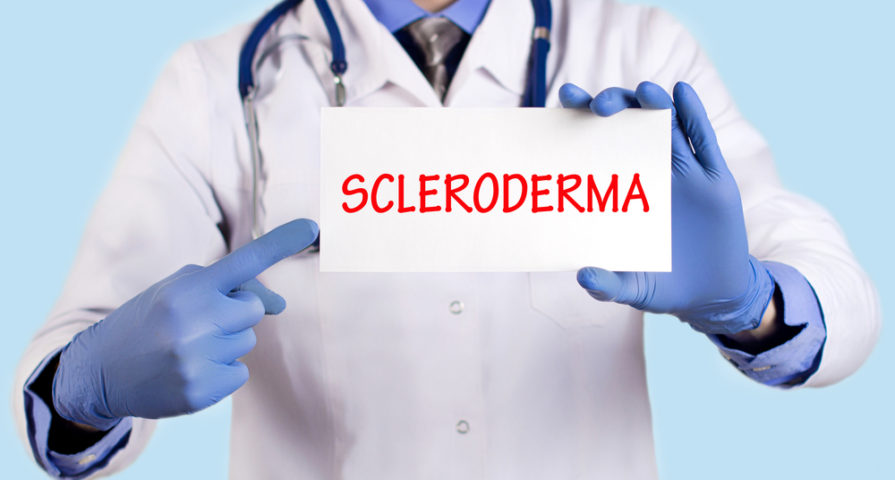 Scleroderma: What You Need to Know - ActiveBeat