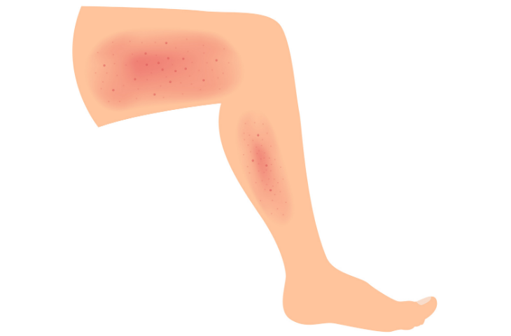 Facts and Risk Factors of Cellulitis - ActiveBeat