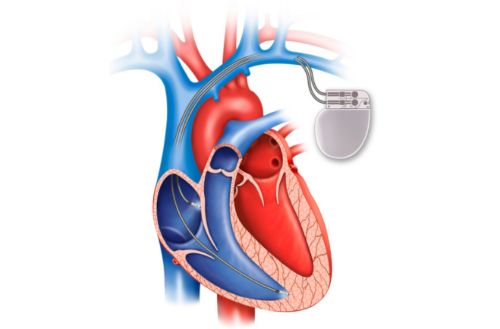 A Complete Guide to Living With a Pacemaker - ActiveBeat